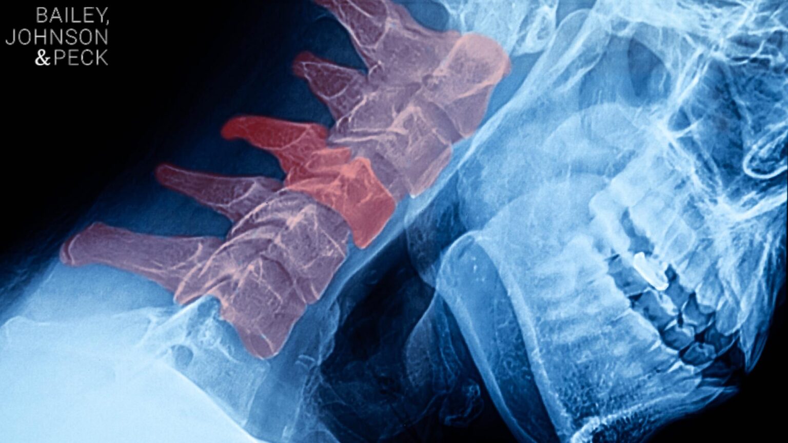 What is a C5/C6 Injury? | Bailey, Johnson & Peck, P.C.